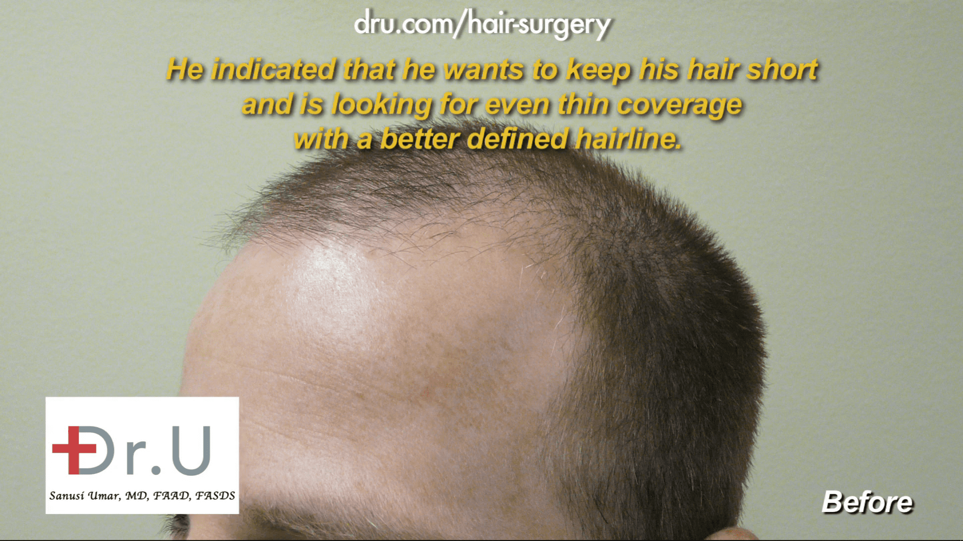 Video - The Hair Transplantation Less is More Approach Using Dr.UGraft