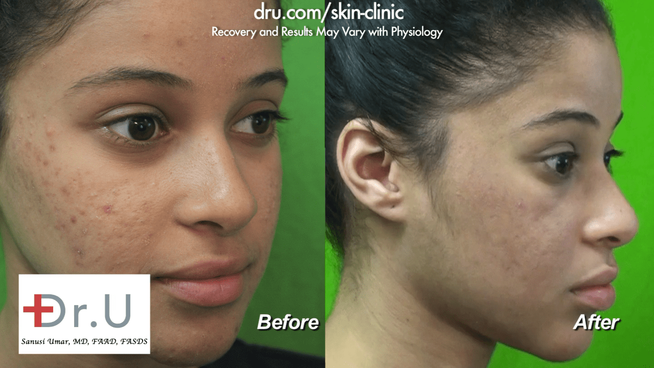 VIDEO: Spectra Laser Treatment for Acne | Santa Monica, Los Angeles Patient