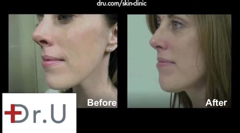 Video: Bel Air Patient Learns How to Get Rid of Laugh Lines with Fillers