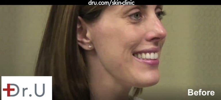 Video: Bel Air Patient Learns How to Get Rid of Laugh Lines with Fillers