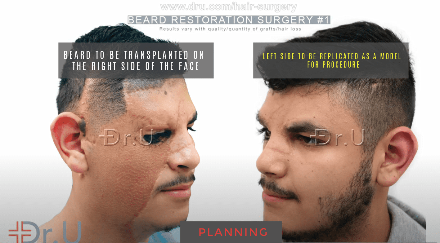 Beard Construction Surgery For A Los Angeles Teen