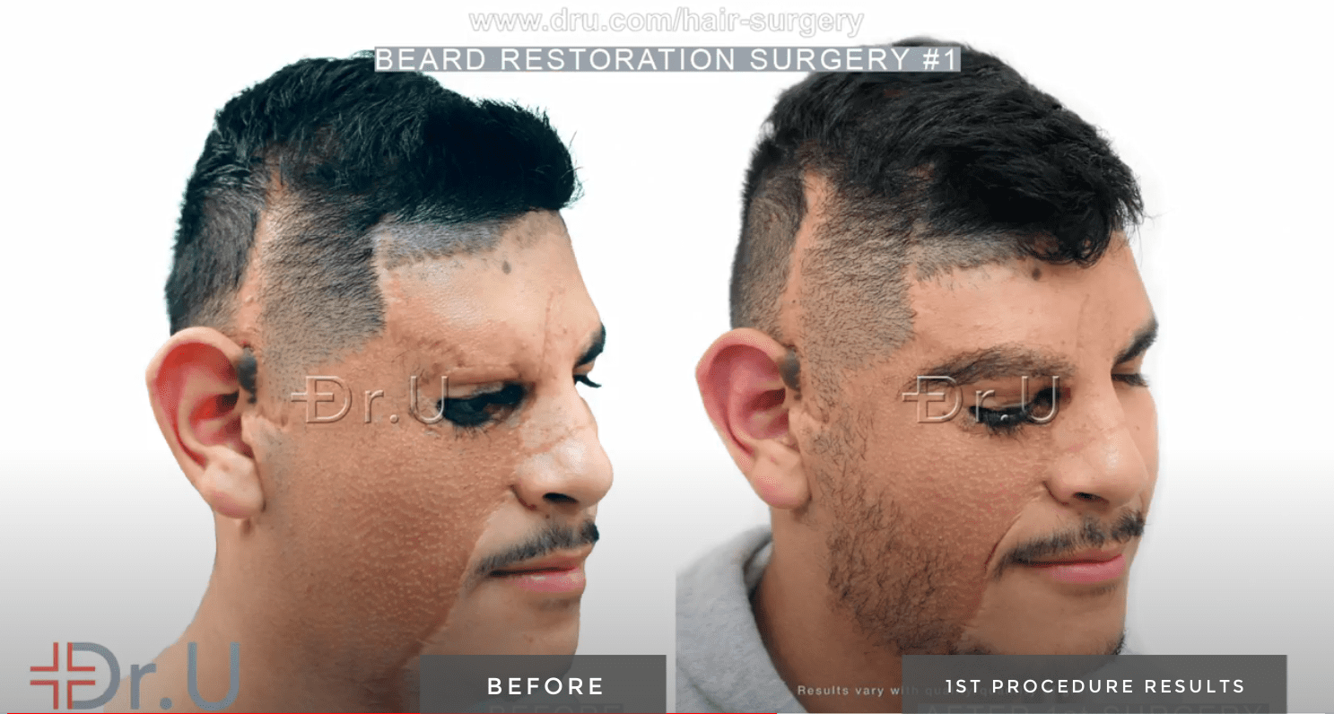 Beard Construction Surgery For A Los Angeles Teen